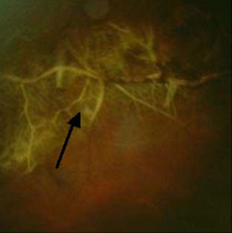Degeneración Lattice - Retina en México