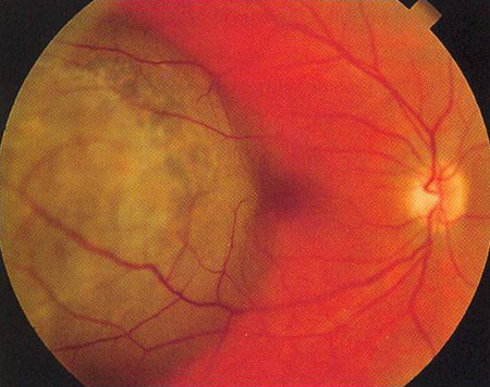 Melanoma uveal - Retina en México
