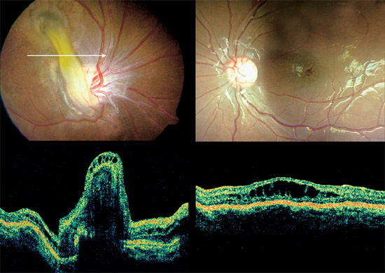 Toxocariasis ocular - Retina en México